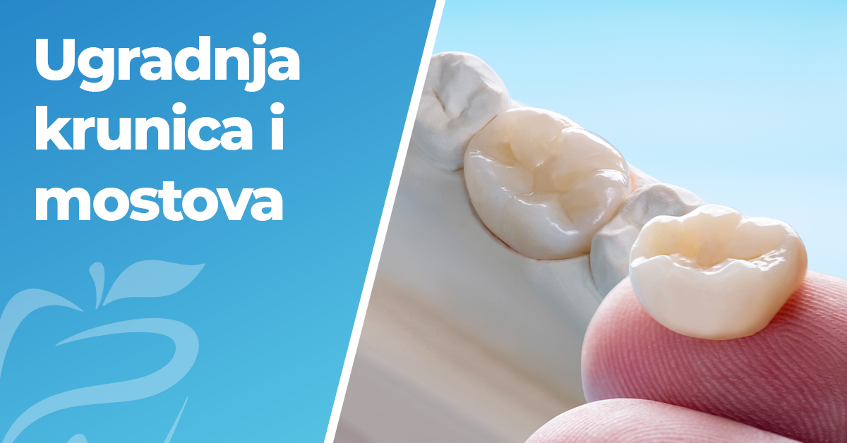 Ugradnja mostova i krunica - Jelena Dental
